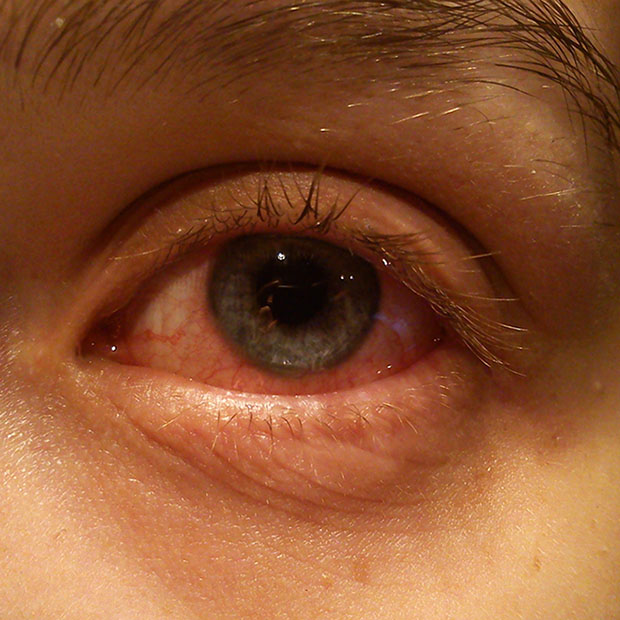 What Is Pink Eye? – Riverside CA | Hip Optics Vision Source